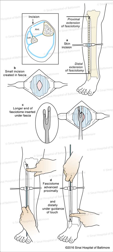 Surgical Procedures To Treat Fibular Hemimelia International Center For Limb Lengthening