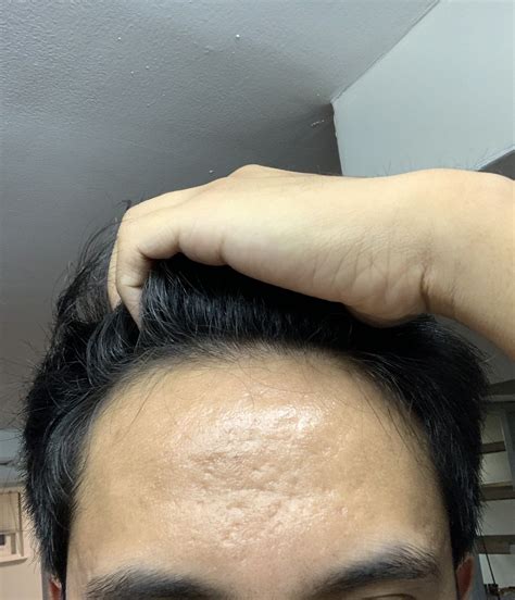 Pimple Scars On Forehead