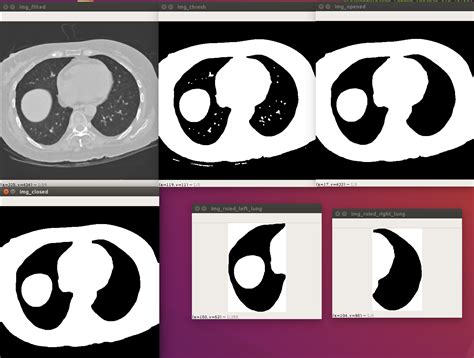 Github Vinaybn Lung Cancer Detection Using Python Lung Cancer Detection From Images