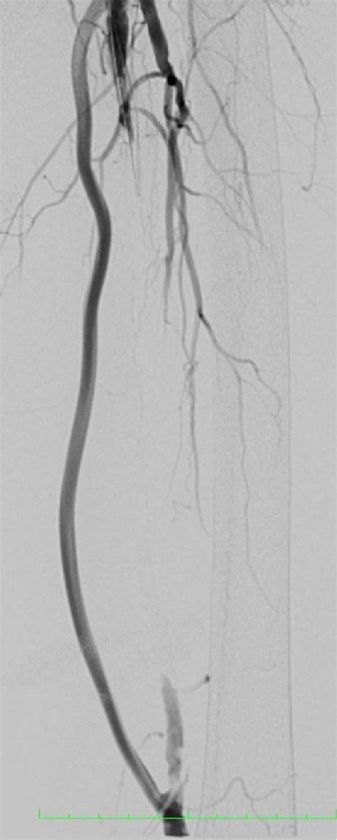 Figure 1 From Hybrid Treatment For Lower Limb Revascularization In A