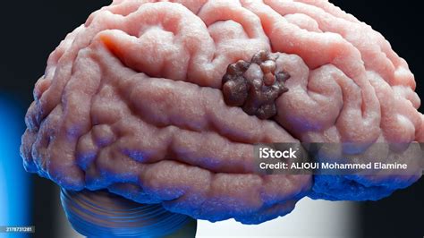 Human Brain Nervous System Anatomy Neural Cancer Sebaceous Bulb Brain
