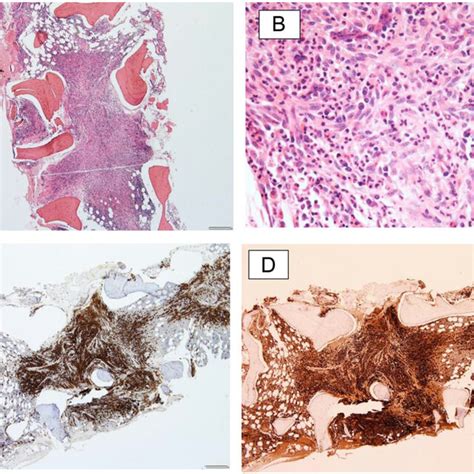 A D Bone Marrow Biopsy Demonstrating Infiltration Of Bone Marrow By Download Scientific