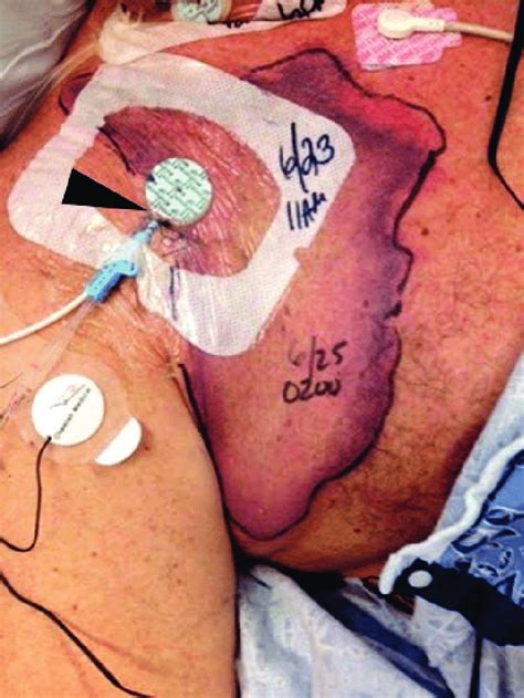 Extravasation Injury Area Around Right Infraclavicular Central Venous
