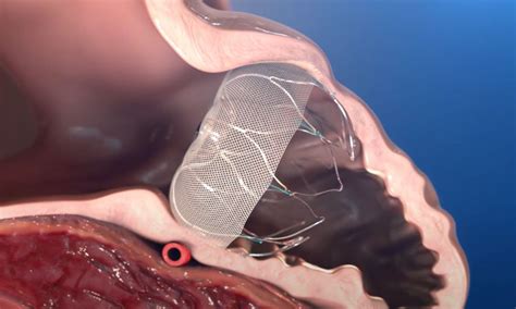 19 Pros And Cons Of Watchman Device