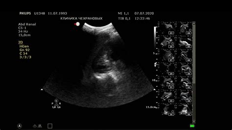 УЗИ органов брюшной полости Желчекаменная болезнь Сладж и камни желчного пузыря в 26 лет