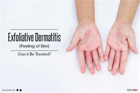 Exfoliative Dermatitis Face