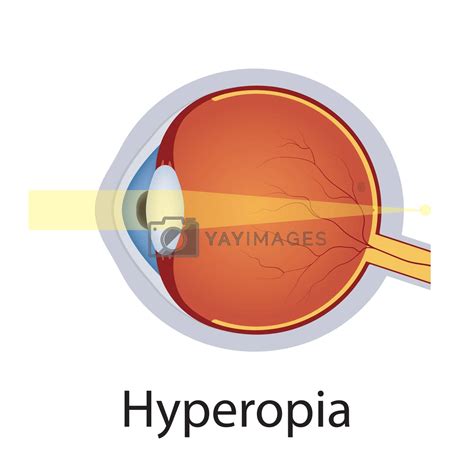 Hyperopia And Vision Disorders Illustration Eyes Defect Concept Detailed Anatomy Eyeball With