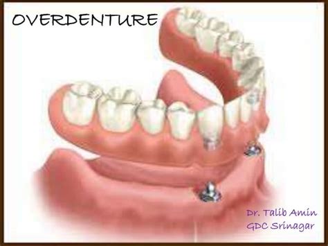 Overdenture Pptx