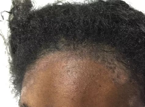 Psoriasis On Black Skin Pictures And Diagnosis Mypsoriasisteam