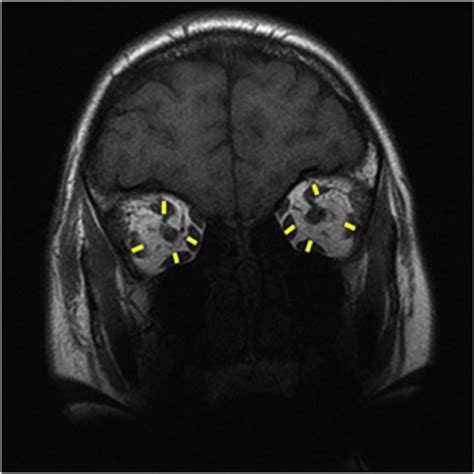 Pdf Shingles As The Underlying Cause Of Orbital Myositis In An
