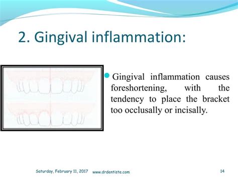 Mbt Bracket Placement Ppt