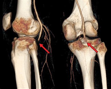 Radiologic Review Of Knee Dislocation From Diagnosis To Repair Ajr