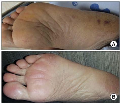 Osler Nodes Endocarditis