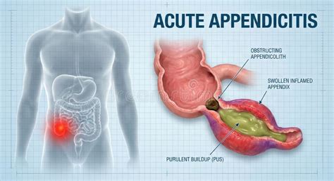 Human Anatomy Illustration Acute Appendicitis Medical Diagnosis