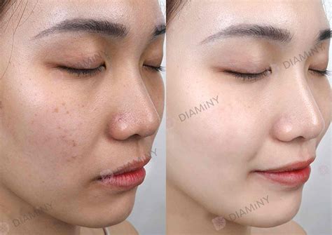 Non Cross Linked Hyaluronic Acid Diaminy Medical Aesthetics