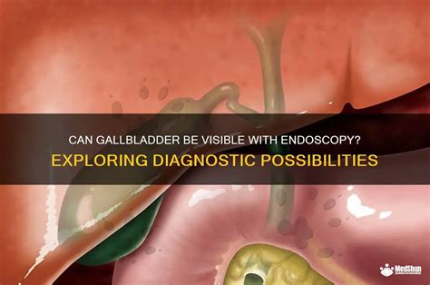 Can Gallbladder Be Visible With Endoscopy Exploring Diagnostic Possibilities Medshun