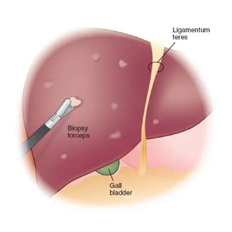Liver Biopsy Dr Christian Jeske