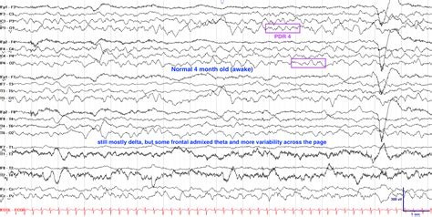 The Pediatric Eeg