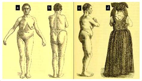 Neugebauers 45 Year Old Patient A Frontal Clinical View Showing Download Scientific Diagram