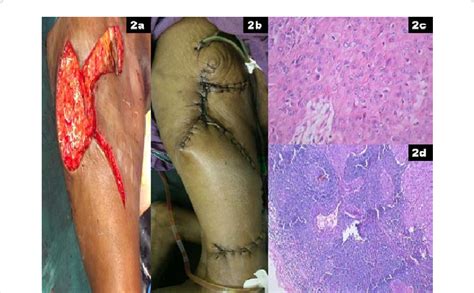 2a Modification Of Conventional Inguinal Block Dissection Incision To Download Scientific