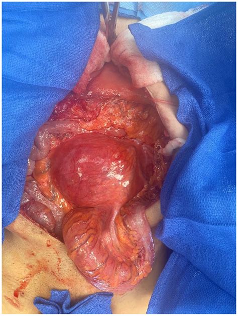 Delayed Abdominal Aortic Aneurysm Sac Rupture After Open Repair