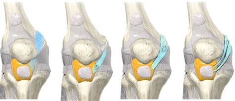 La Plica Sinovial De La Rodilla Ecografía Anatomía Y Tratamientos Easy Fisioterapia