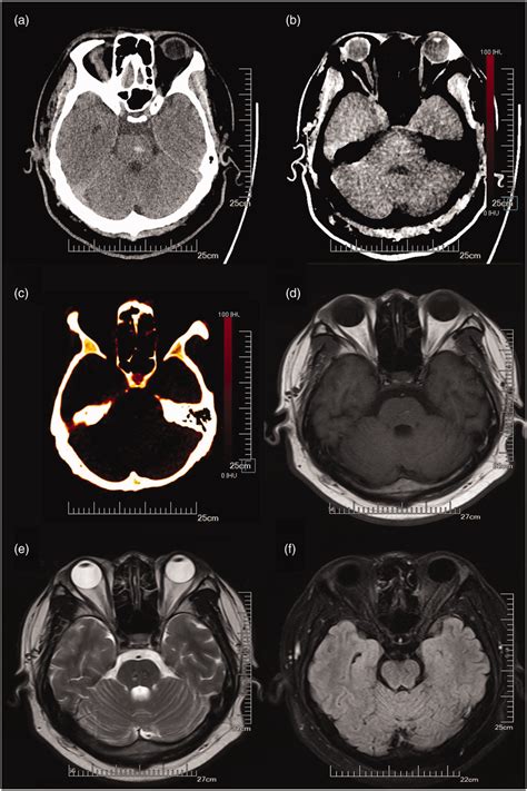 Conventional Computed Tomography Shows An Unidentified Lesion