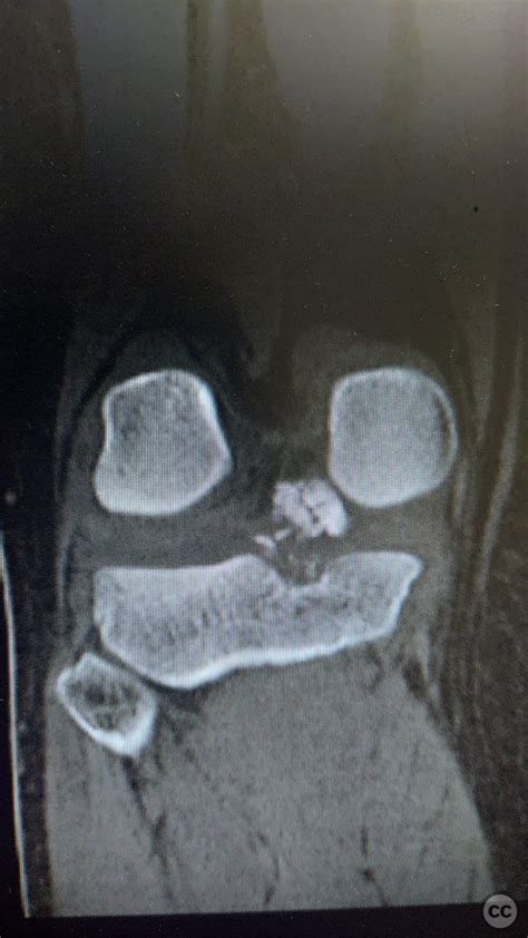 Tibia Pcl Avulsion Fracture