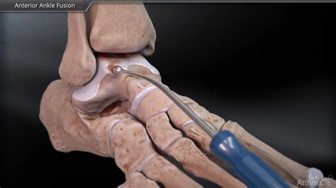Arthrex Ankle Fusion Plating