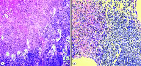 A Frozen Section Of Lymph Node Metastasis Of Squamous Cell Carcinoma Download Scientific