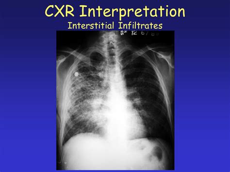 Introduction To Radiographic Interpretation Special Emphasis On Cxrs