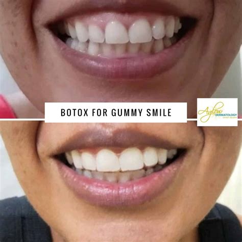 How To Use Botox®for A Gummy Smile Aglow Dermatology