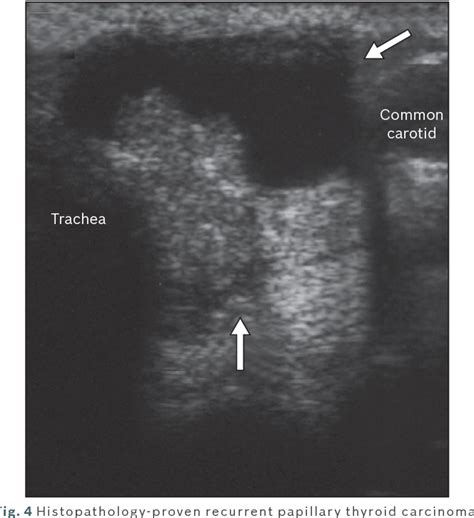 [pdf] Post Thyroidectomy Neck Ultrasonography In Patients With Thyroid Cancer And A Review Of