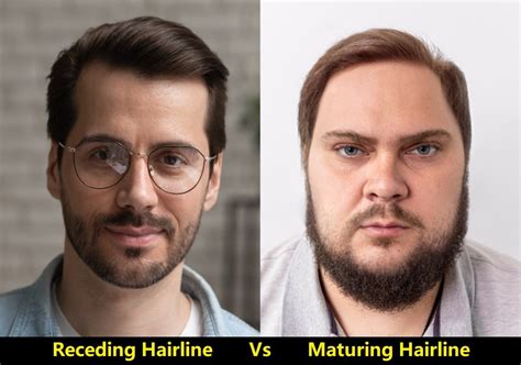 Maturing Hairline Vs Receding Hairline Whats The Difference
