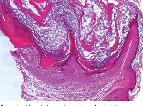 Epidermolytic Ichthyosis Symptoms Successful Topical Adapalene