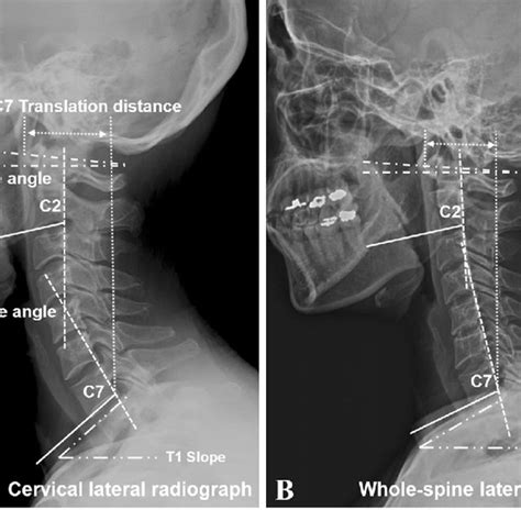 Pdf Does Whole Spine Lateral Radiograph With Clavicle Positioning Reflect The Correct Cervical