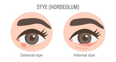External And Internal Stye Of The Eye Medical Concept Of Stye Eye
