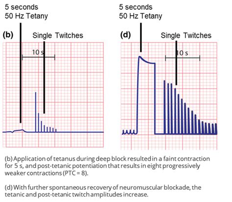 How To Use Post Tetanic Count Ptc To Manage Neuromuscular Blockade