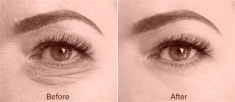 Best Lumi Eyes Treatment Reigate From £100 Book Now