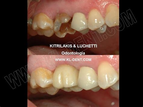 Kitrilakis And Luchetti Dentistry Dental Implant In Upper Molar Case 2