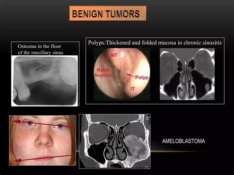 Maxillary Sinus Sinus Pptx