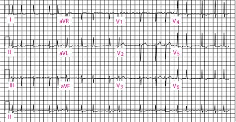 Imagefibrilación Auricular Manual Msd Versión Para Profesionales