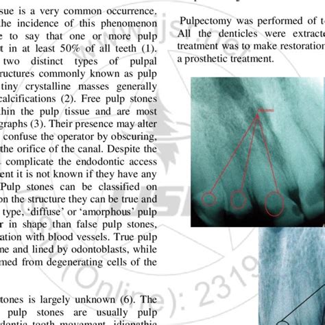 PDF Calcification Of Pulp Tissue In Permanent Dentition A Case Report
