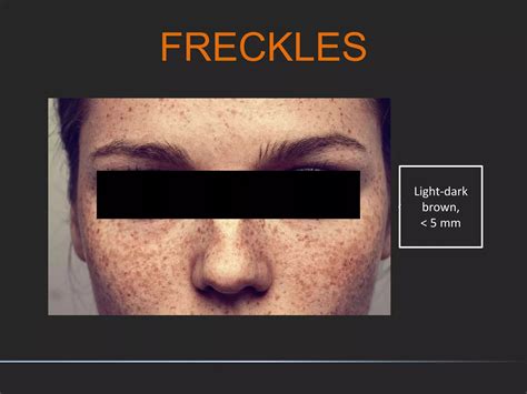 Overview Of Hyperpigmentation Disorders Pptx