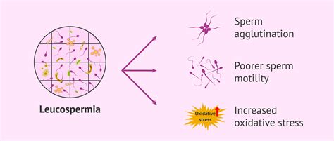 Increased Leukocyte Count In Semen And Pregnancy
