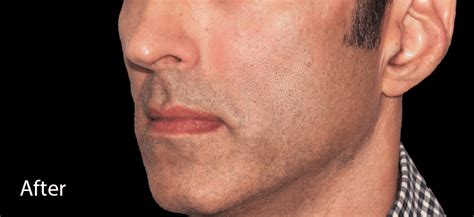 Medical Rejuvenation Centre In Vancouver Skin Cv