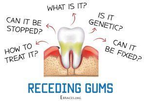 How To Prevent Stop And Even Reverse Receding Gums