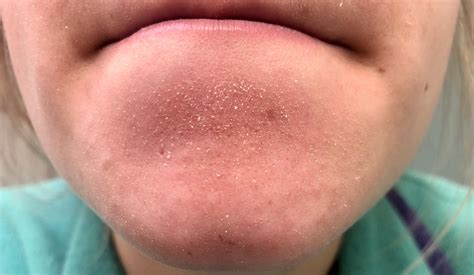 White Stuff That Comes Out Of Pores Captions Quotes