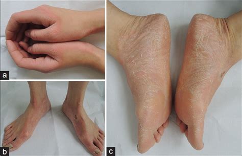Progressive Symmetric Erythrokeratoderma With Dermatophytosis Indian Journal Of Dermatology