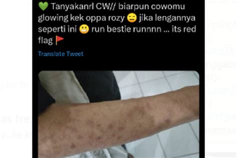 Foto Benarkah Banyak Bekas Luka Di Lengan Termasuk Gejala Sifilis